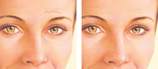 Scar Revision | Minimize a Scar | Kawartha Plastic Surgery