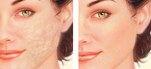 Scar Revision | Minimize a Scar | Kawartha Plastic Surgery