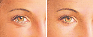 Eyelid Surgery | Blepharoplasty | Kawartha Plastic Surgery