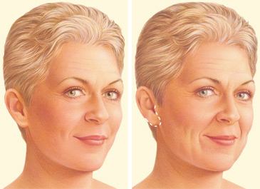 Facelift Surgery | Rhytidectomy | Kawartha Plastic Surgery